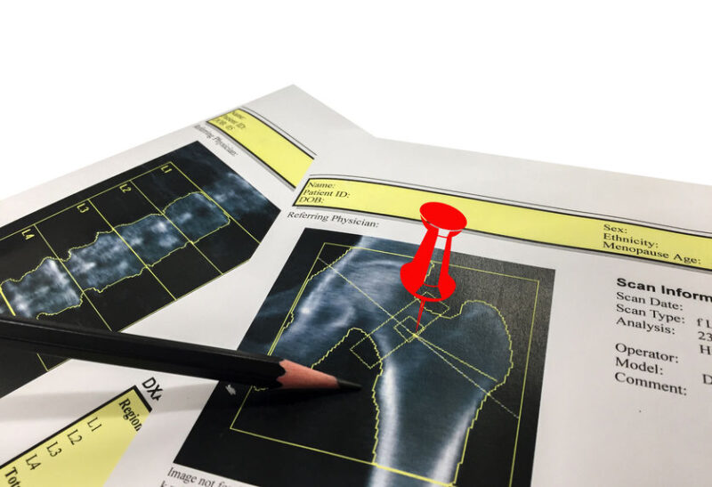 Osteopenia vs Osteoporosis: What's The Difference & How To Fight Low ...